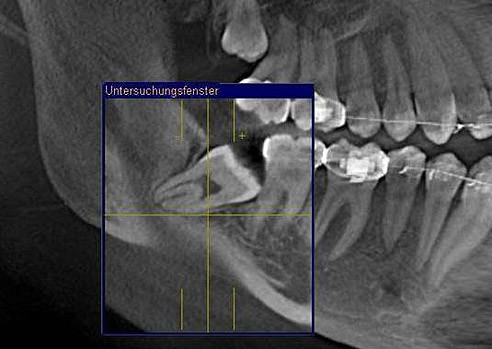 Weisheitszähne | Dr. Beisel