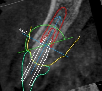 Biodigitale Implantologie | Dr. Beisel