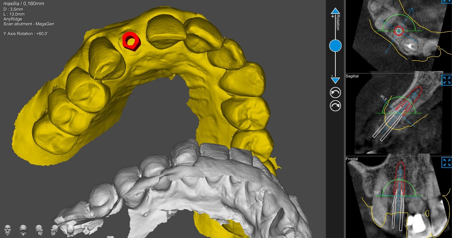 Biodigitale Implantologie | Dr. Beisel